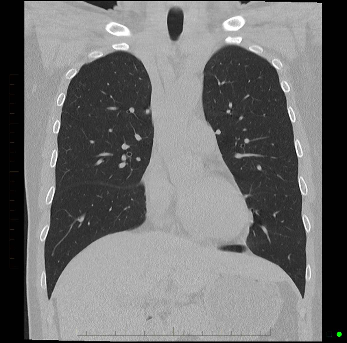 Chest Ct Scan Melbourne Radiology